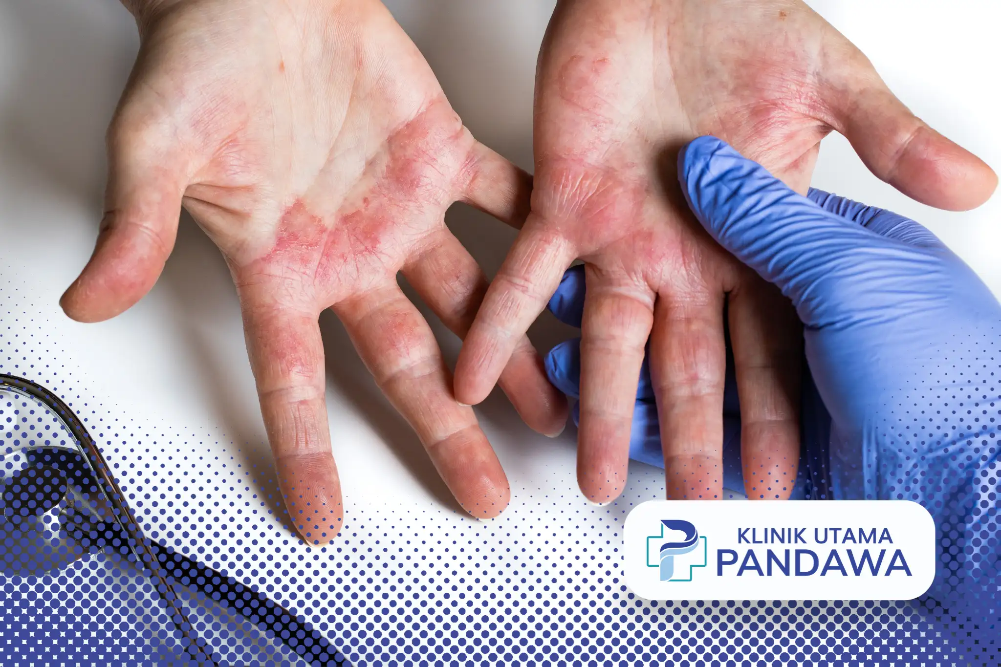 Pilihan Pengobatan Dermatitis Numularis agar Kulit Sehat Kembali ...