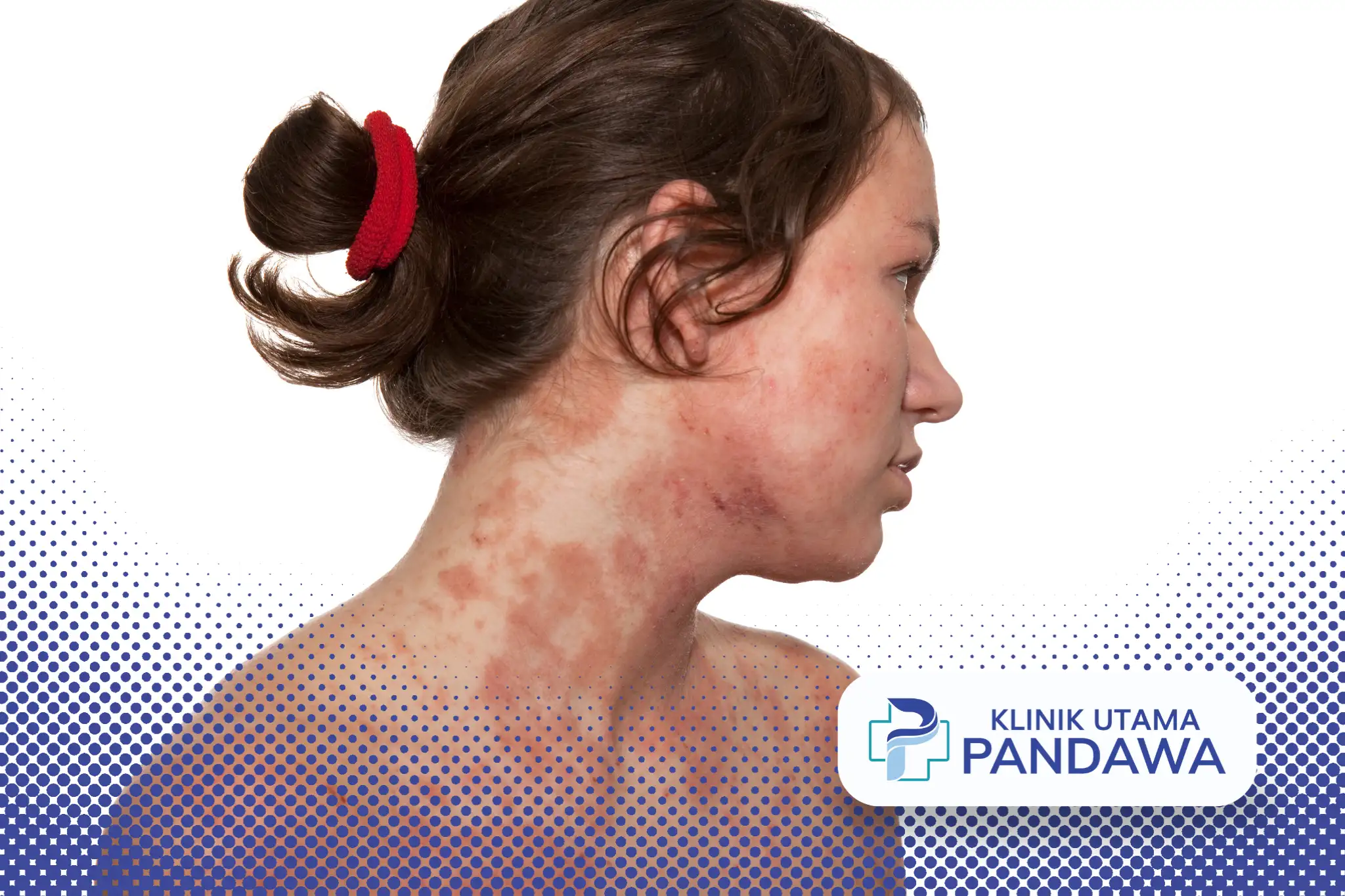 Dermatitis Atopik: Penyebab, Gejala, dan Pengobatan - Klinik Utama Pandawa