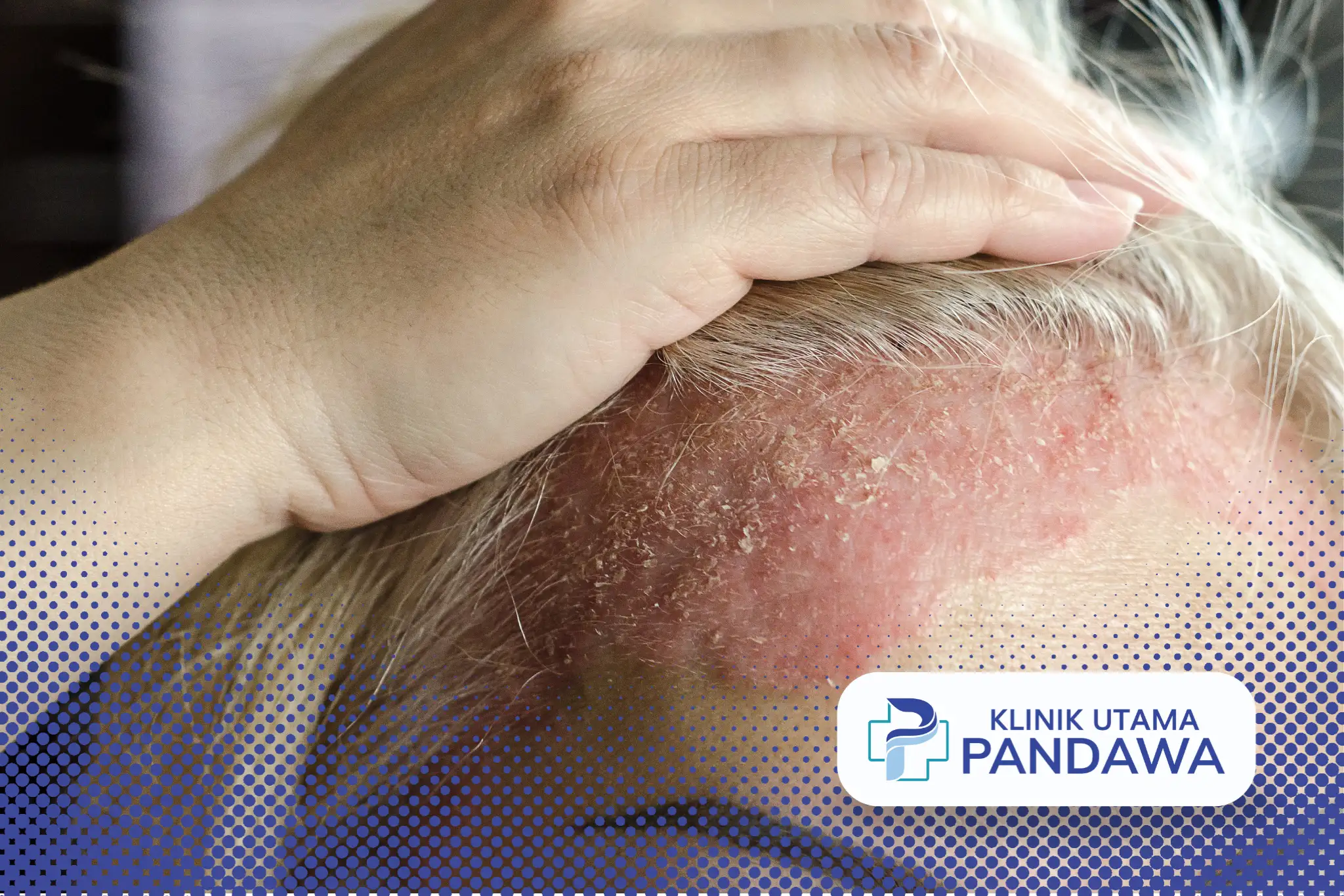 Dermatitis Seboroik: Penyebab, Gejala, dan Penanganan yang Tepat ...