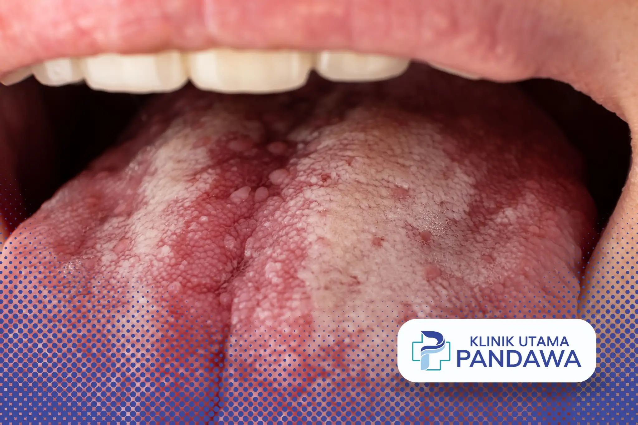 Lidah Ada Bercak Aneh? Waspada Gejala Sifilis Awal! - Klinik Utama Pandawa