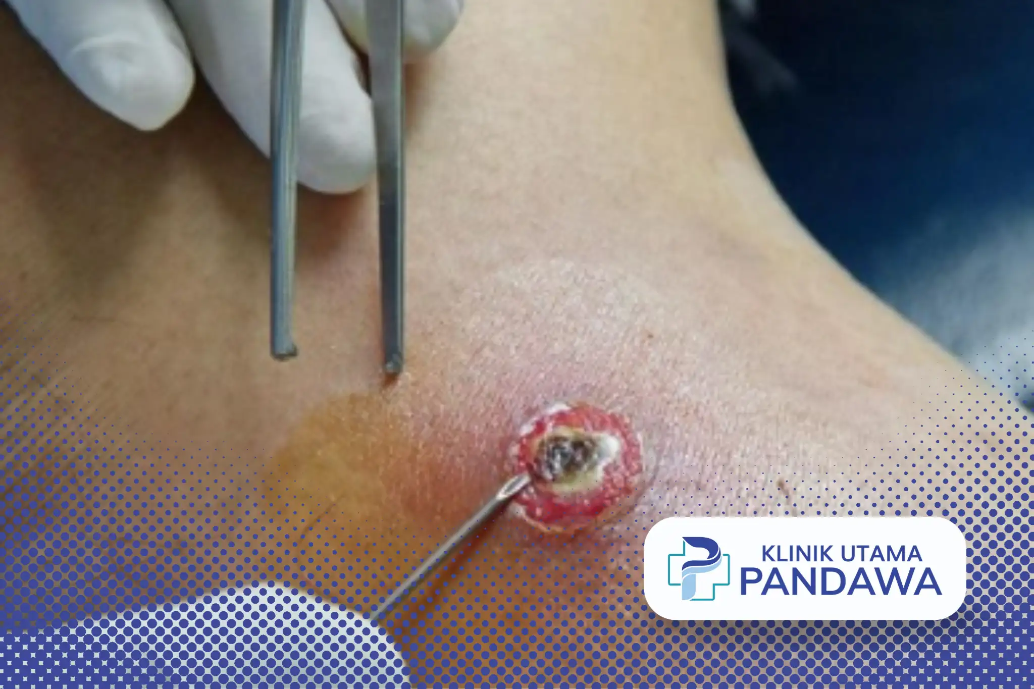 Prosedur Medis untuk Mengatasi Bisul: Kapan Harus Dilakukan? - Klinik ...