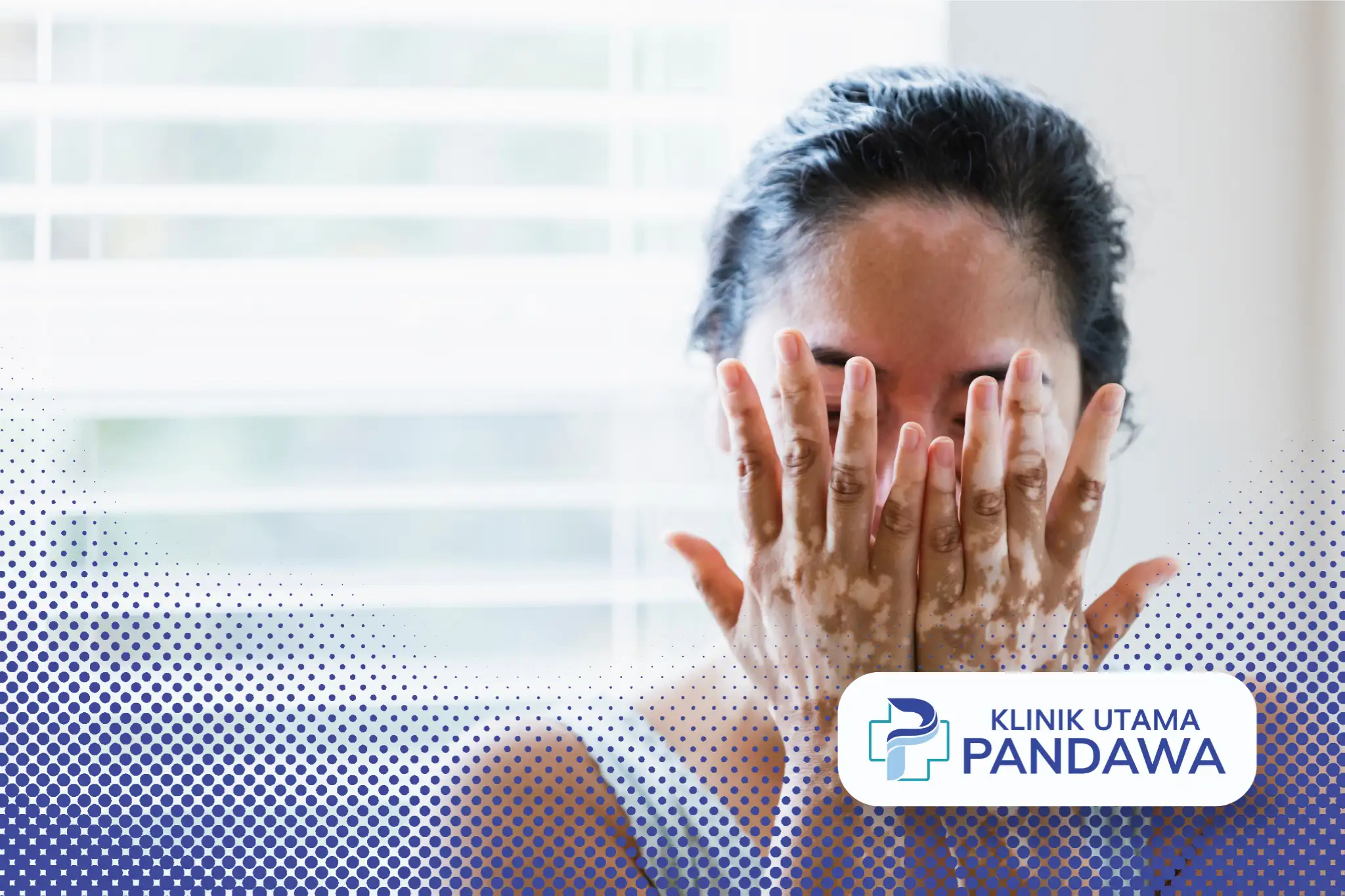 Vitiligo Bukan Menular! Kenali Penyebab dan Solusinya - Klinik Utama Pandawa