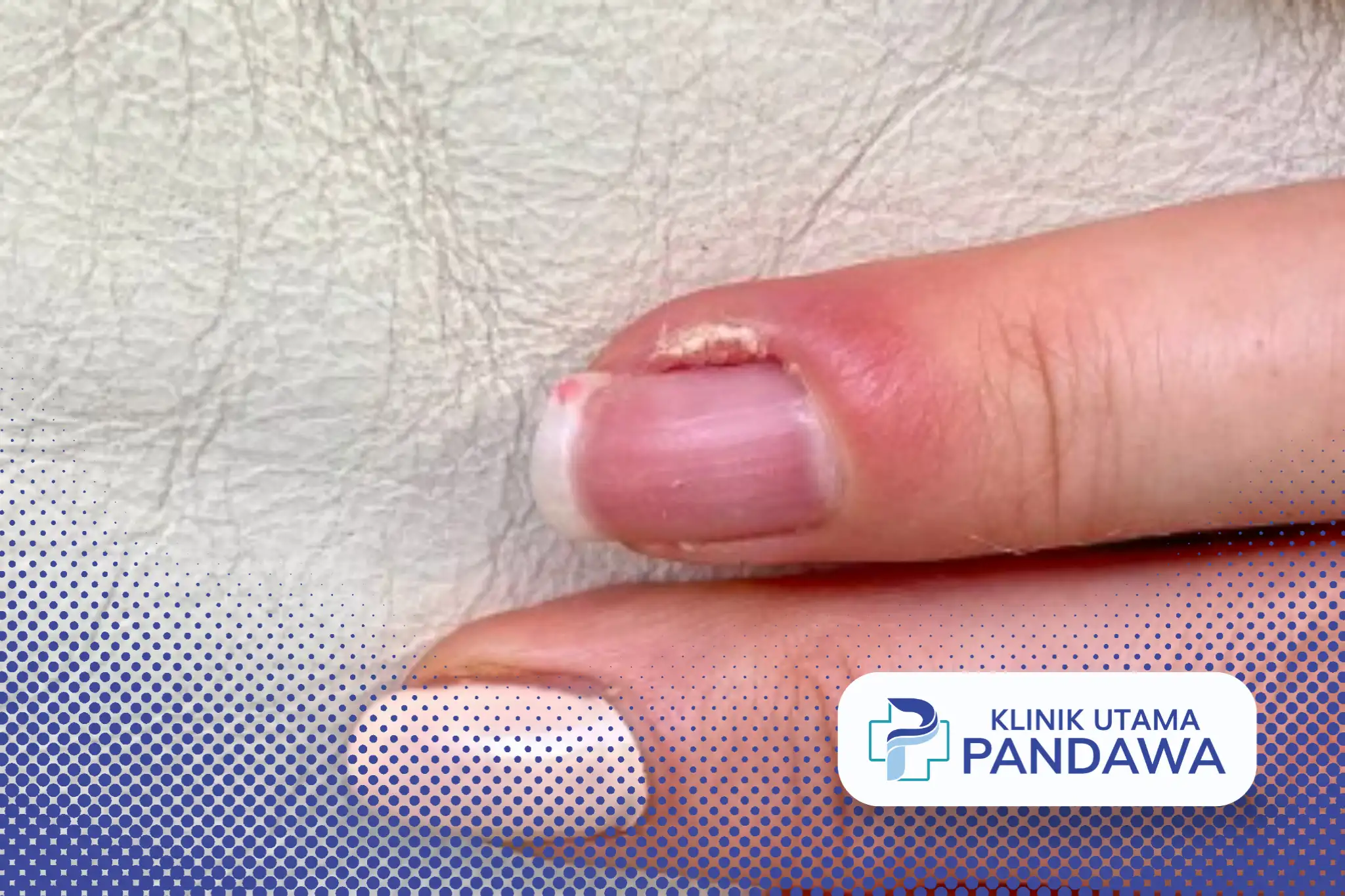 Abses Kuku: Gejala, Penyebab, dan Cara Mengobatinya - Klinik Utama Pandawa