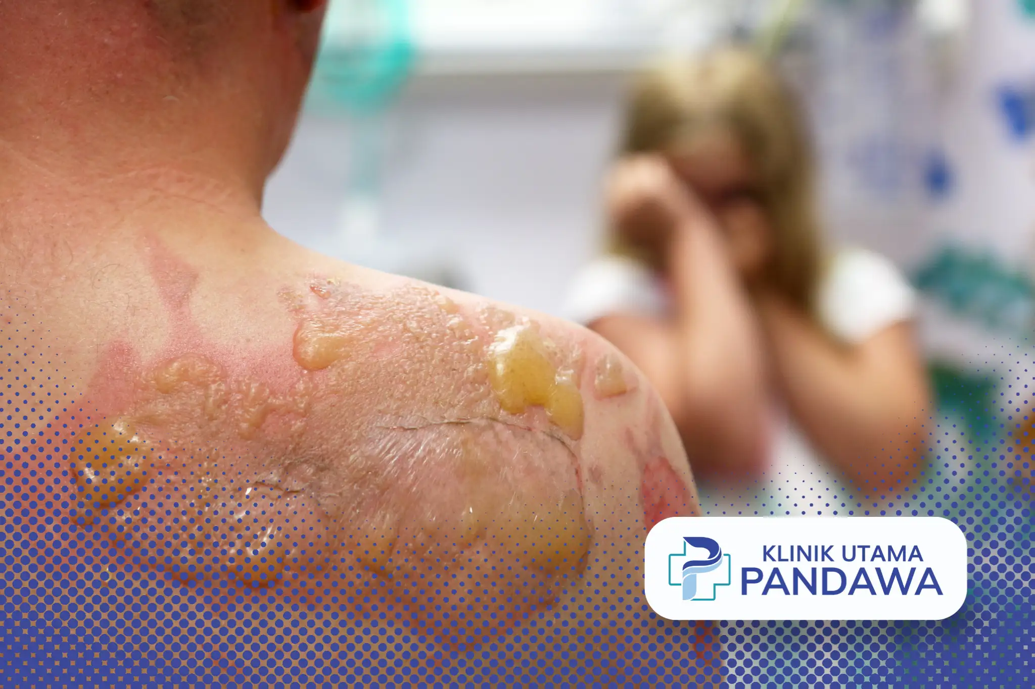 Bentol Berair Makin Parah? Ini Solusi Paling Efektif! - Klinik Utama ...