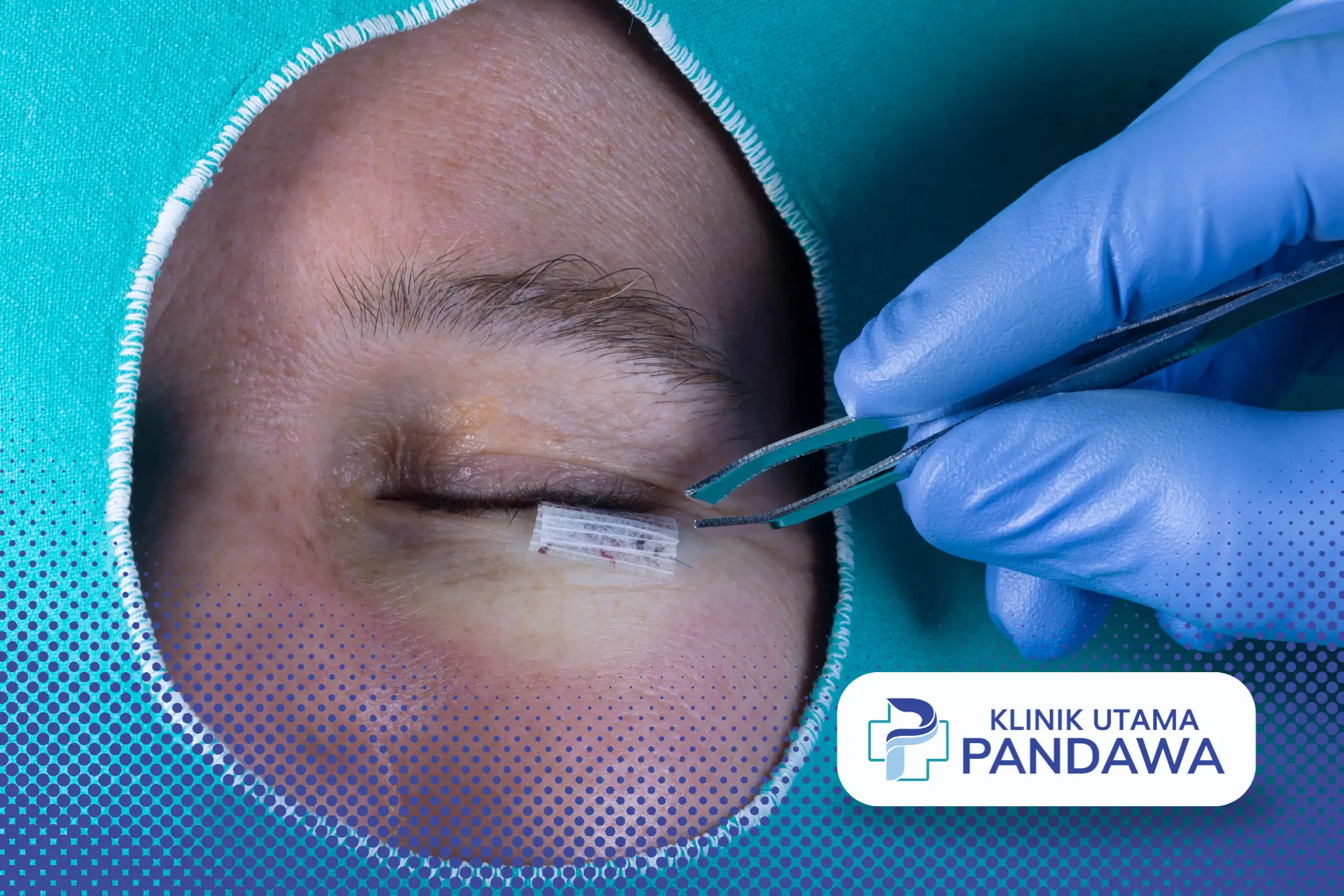 Eyelid Surgery: Solusi Mata Sayu Jadi Lebih Segar - Klinik Utama Pandawa