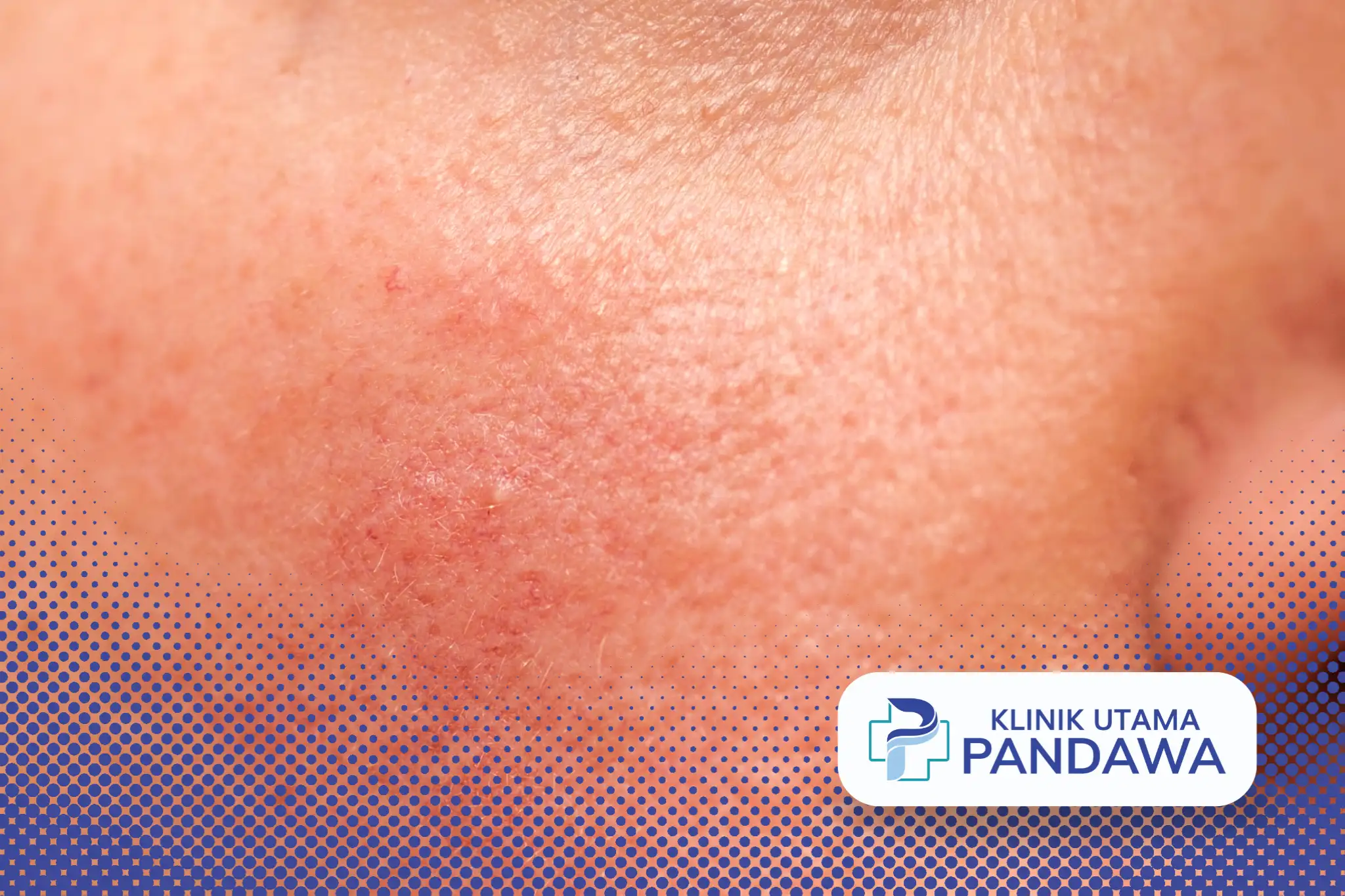 Jarang Disadari! Skin Barrier Rusak Picu Masalah Kulit - Klinik Utama ...