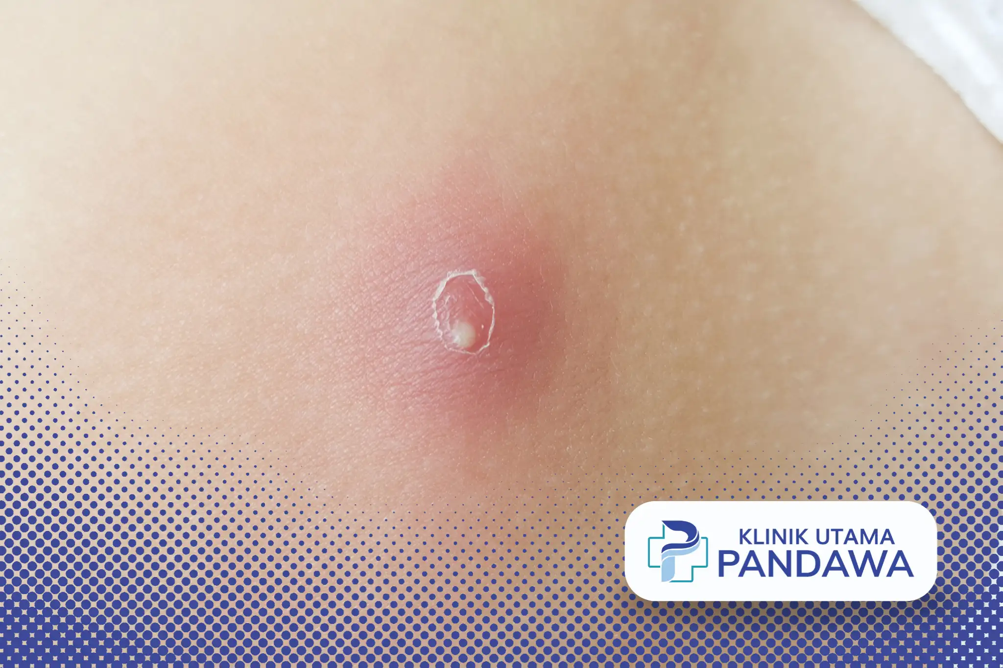 Abses Kulit Bisa Berbahaya? Kenali Tanda dan Faktanya - Klinik Utama Pandawa
