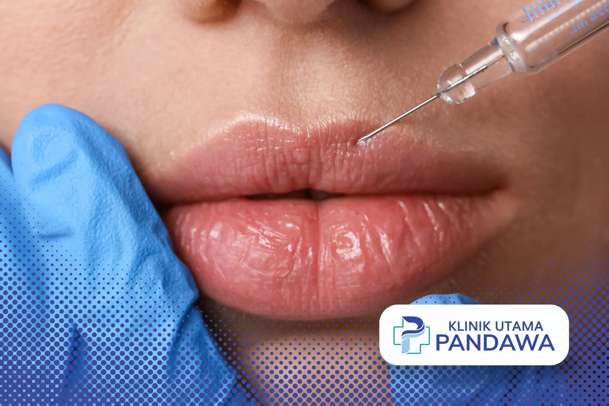 Filler Bibir: Prosedur, Manfaat, dan Hal yang Perlu Diketahui - Klinik ...