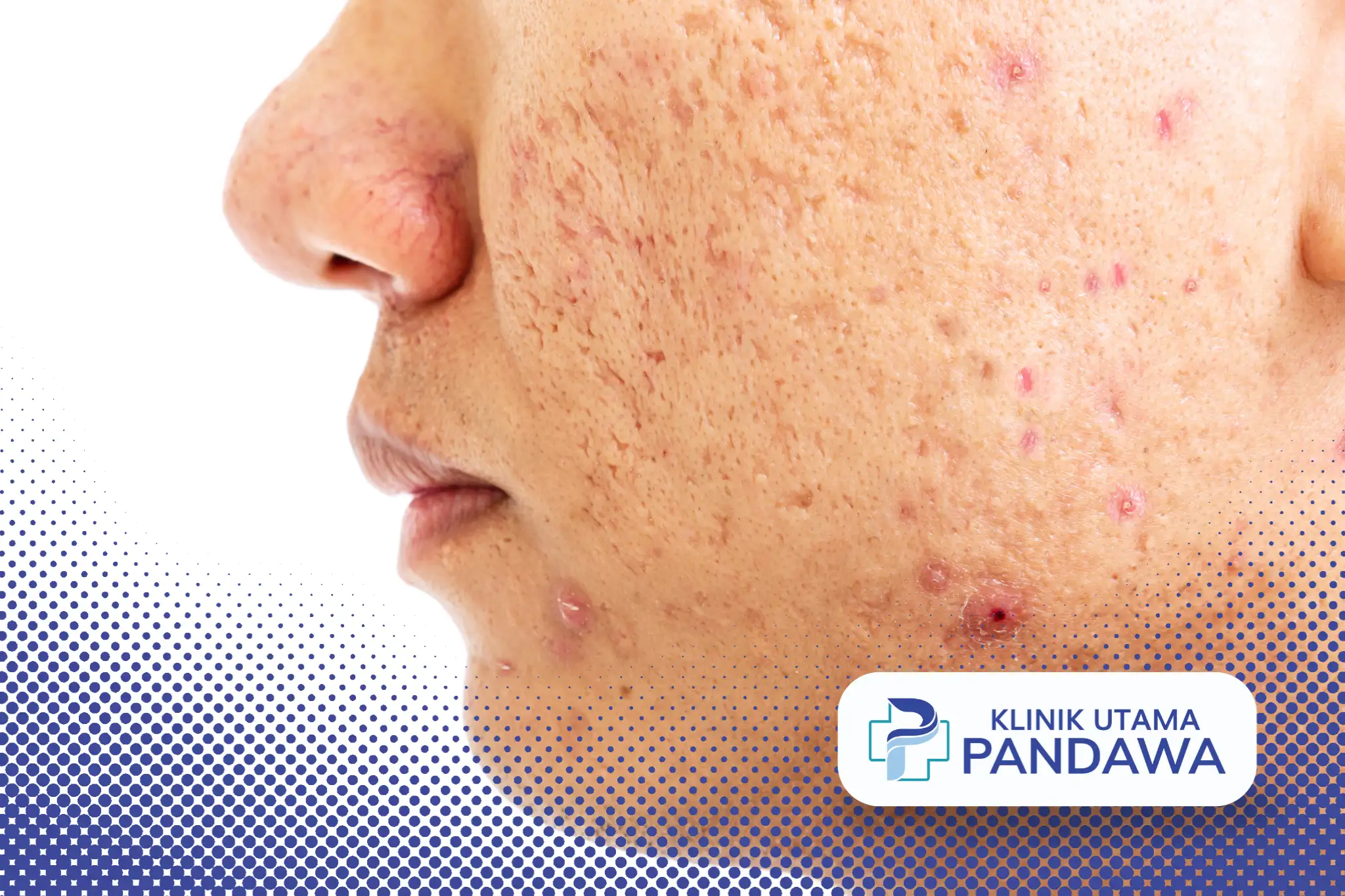 Kenali Jenis-Jenis Bopeng di Wajah dan Cara Mengatasinya - Klinik Utama ...