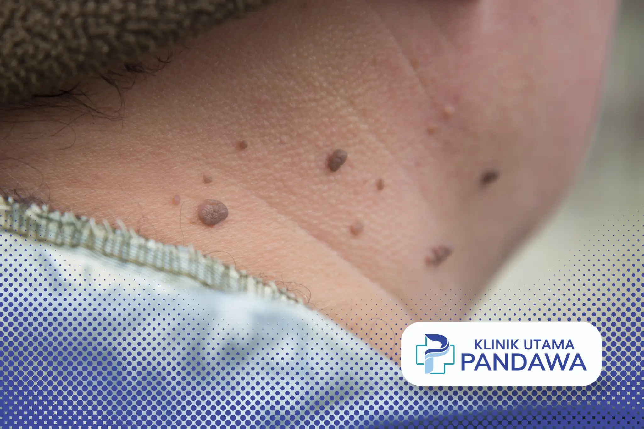 Papiloma di Leher: Penyebab, Ciri-ciri, dan Cara Mengatasinya - Klinik ...