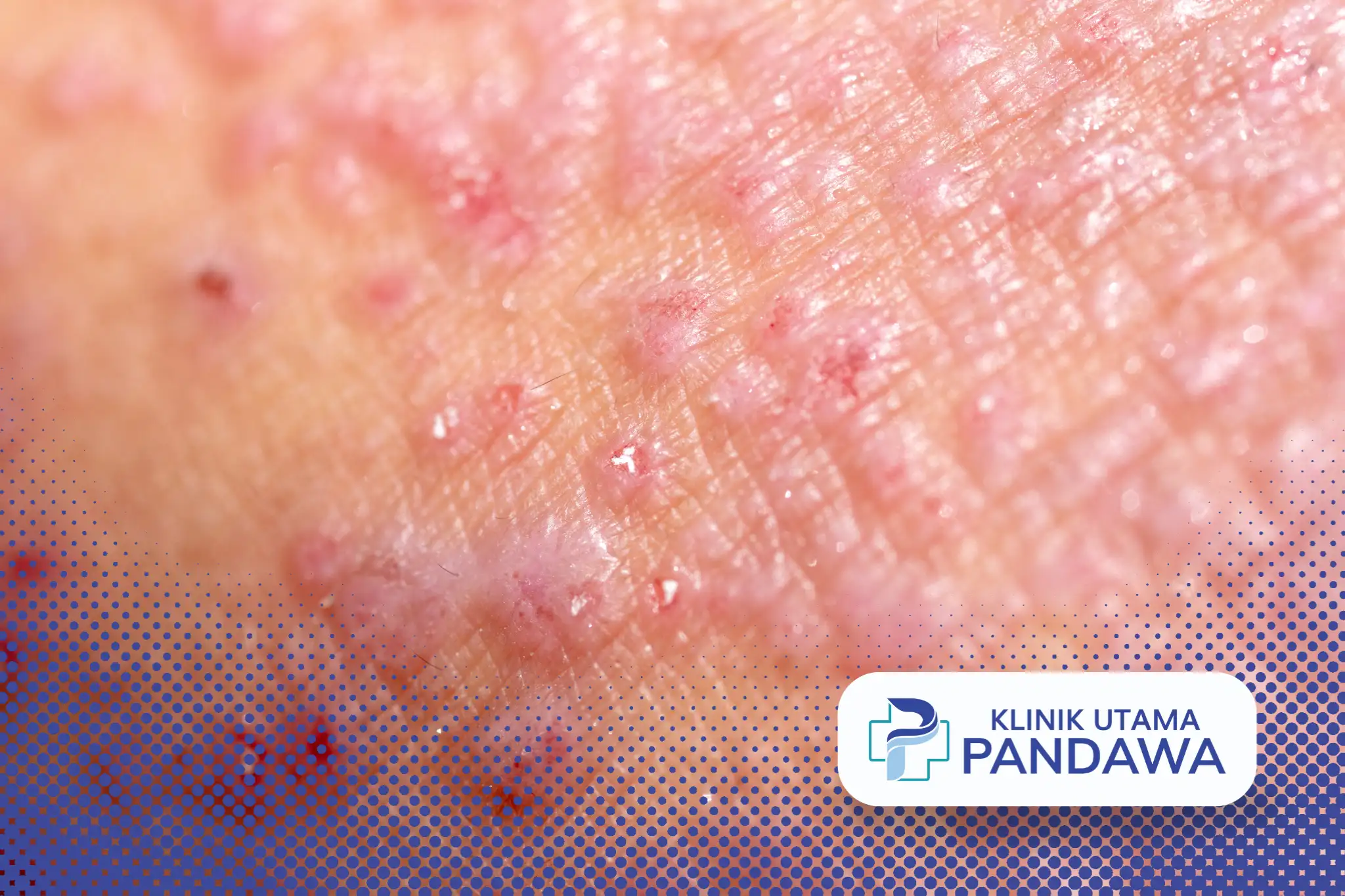 Dermatitis Kontak: Gejala, Penyebab, dan Cara Mengatasinya - Klinik ...