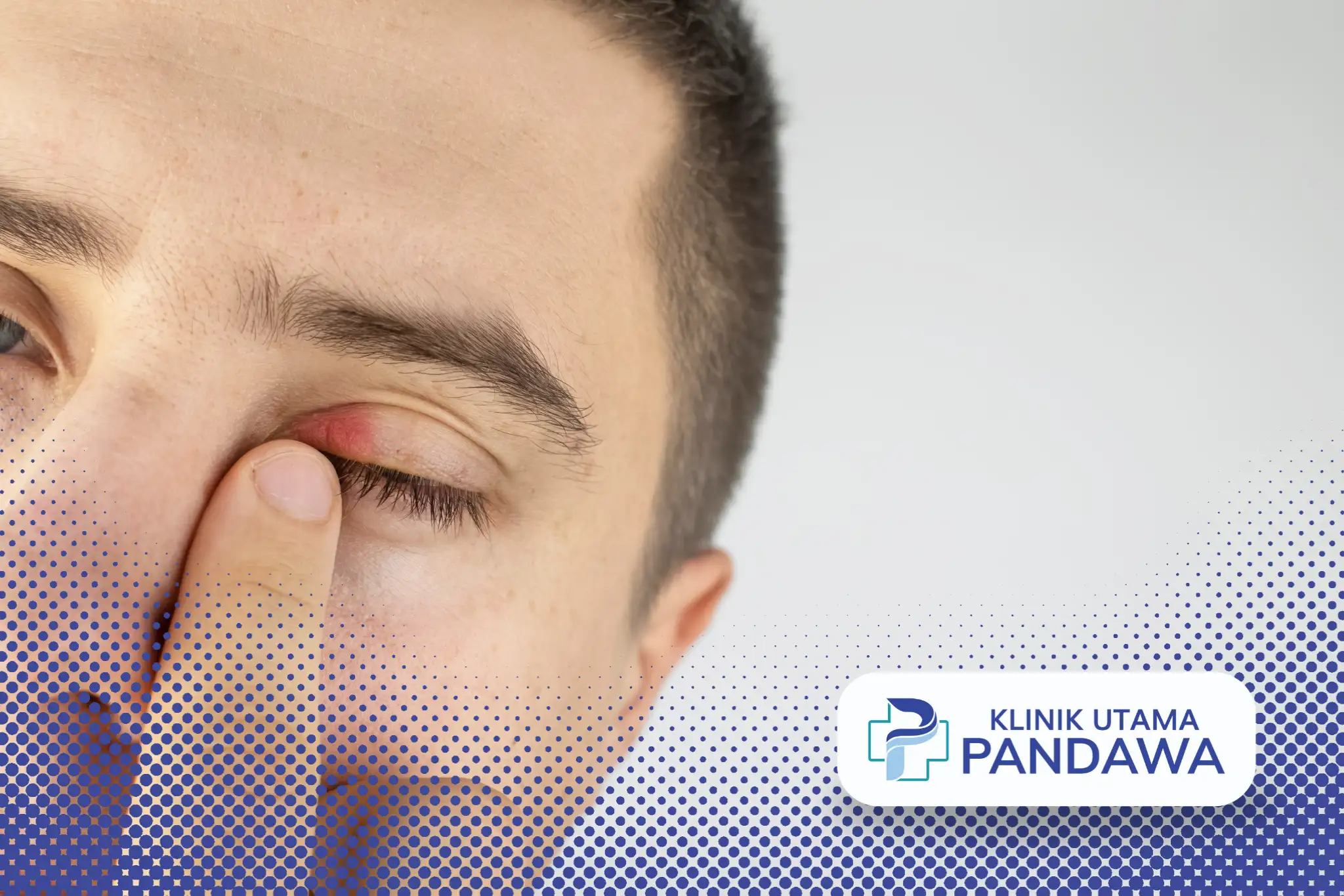 Kelopak Mata Bengkak? Bisa Jadi Ini Penyebabnya! - Klinik Utama Pandawa