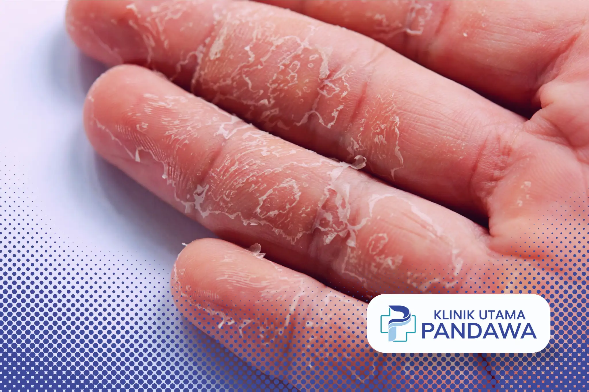 Kulit Tangan Mengelupas Bikin Risih? Begini Cara Mengatasinya! - Klinik ...